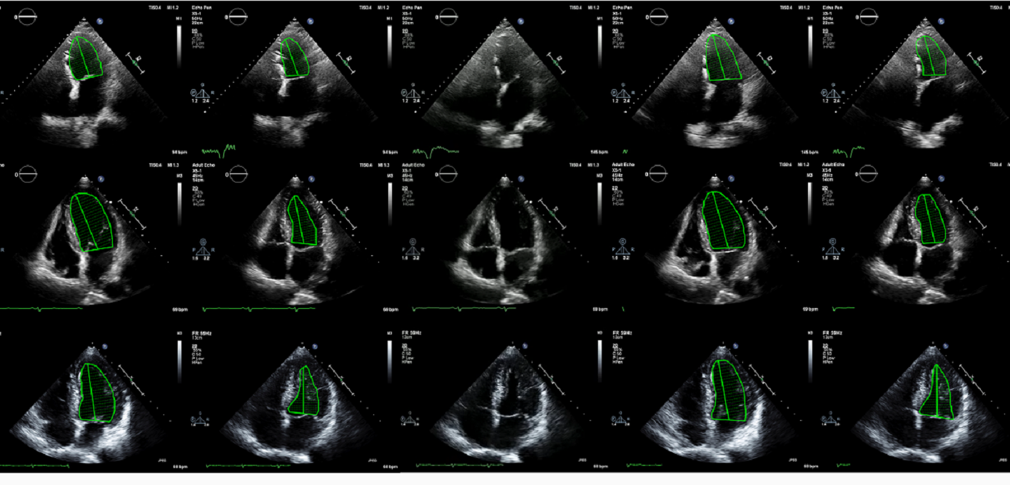 EchoNet AI Algorithm Beats Sonographers for Estimating LV Function | tctmd.com